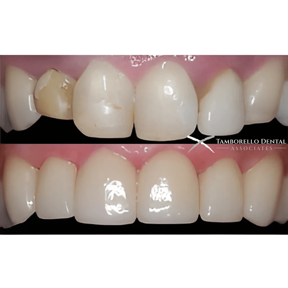 Maxillary Teeth: Understanding Their Importance